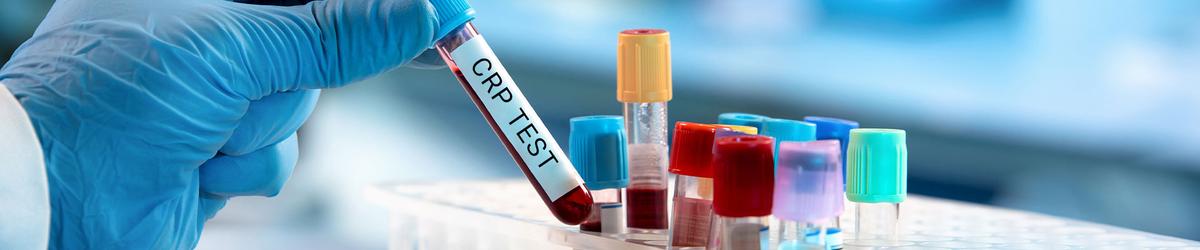 What is a CRP test? | HOD